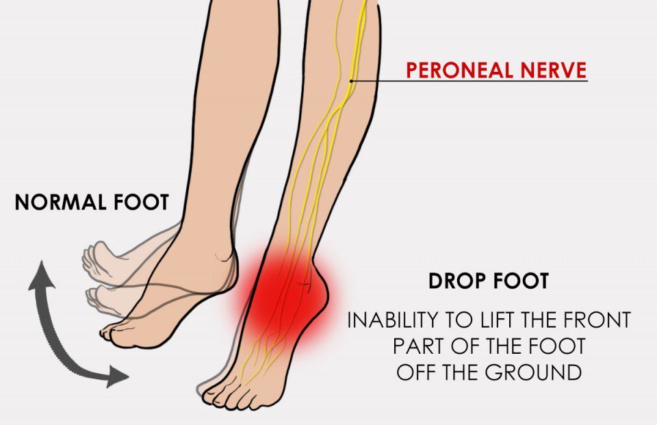 Foot Drop Orchard Health Clinic Osteopathy Physiotherapy And Foot Drop Orchard Health Clinic Osteopathy Physiotherapy And