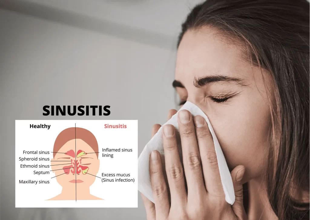 Sinusitis | Orchard Health Clinic - Osteopathy, Physiotherapy and ...
